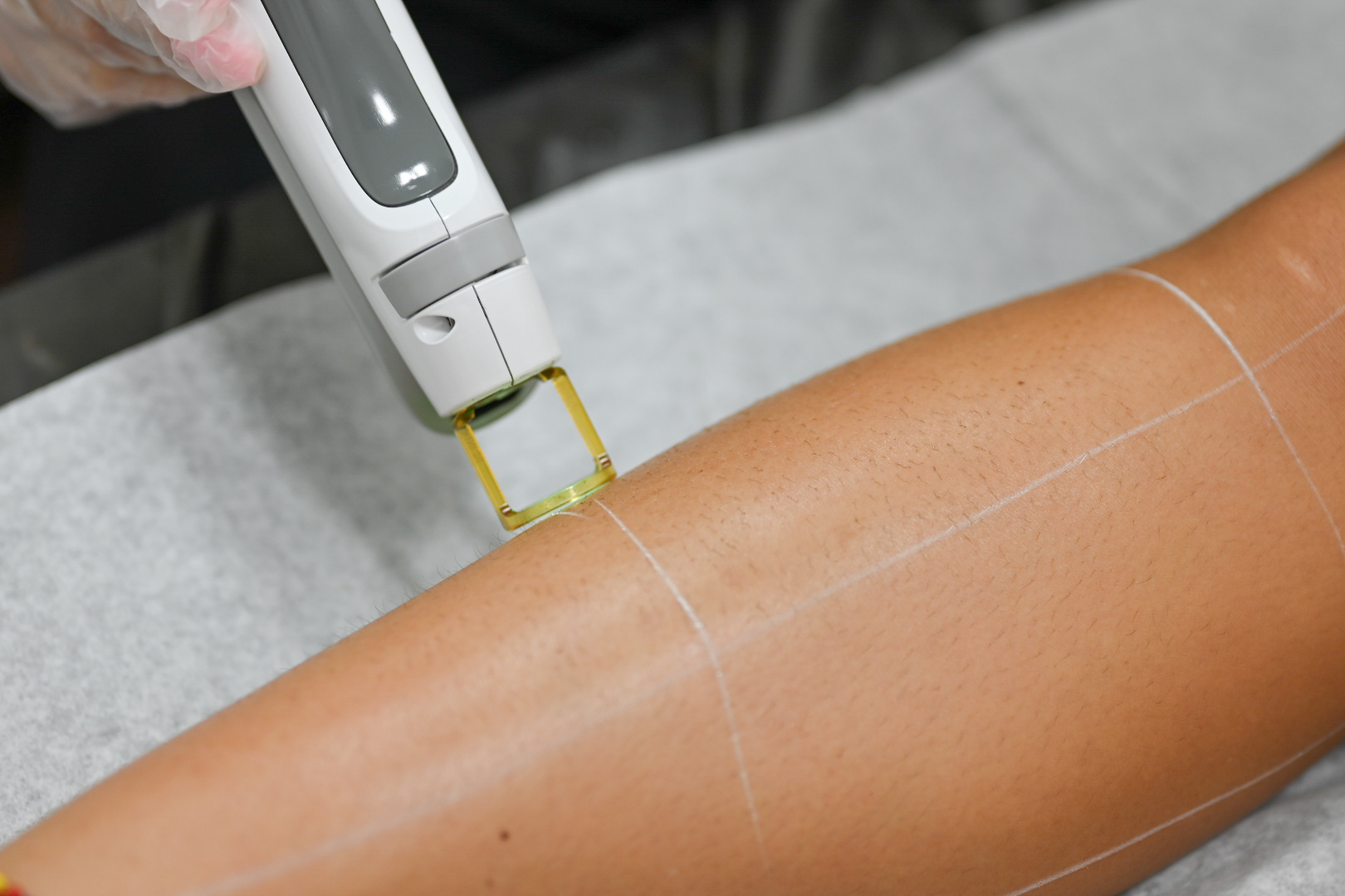 Laser Hair Removal - Jes Laser
